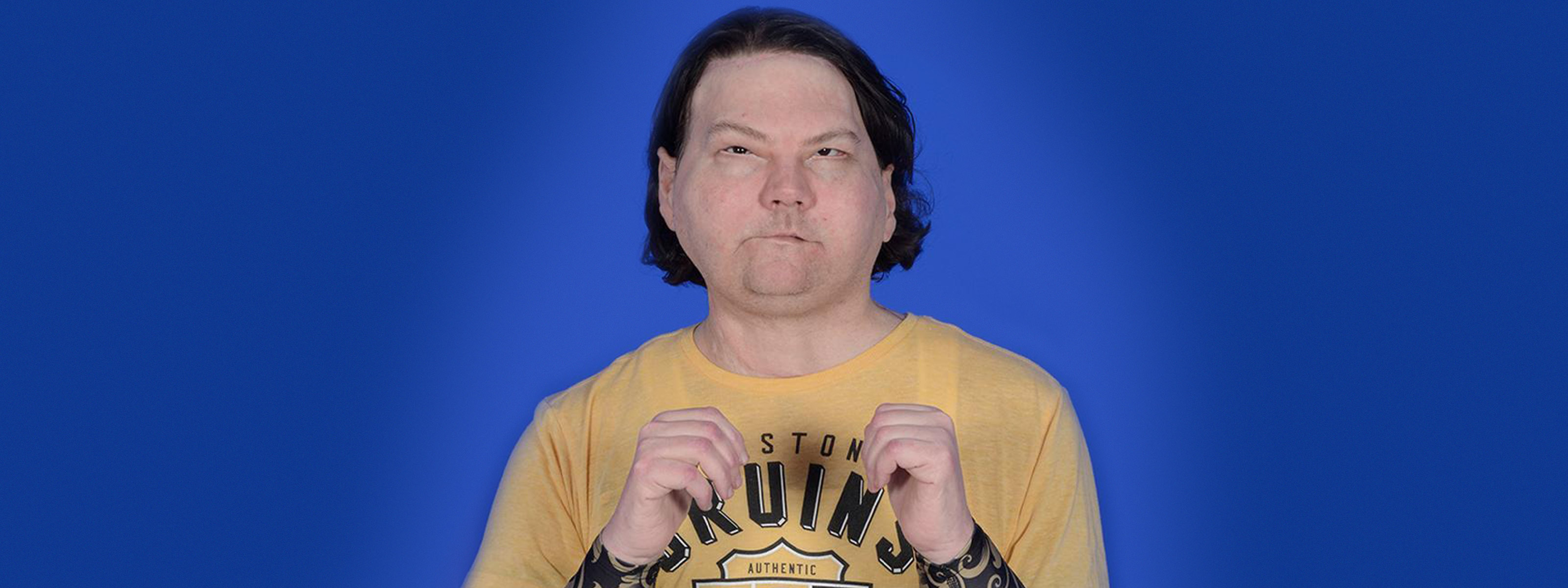 Man's double hand & face transplant may be first to succeed