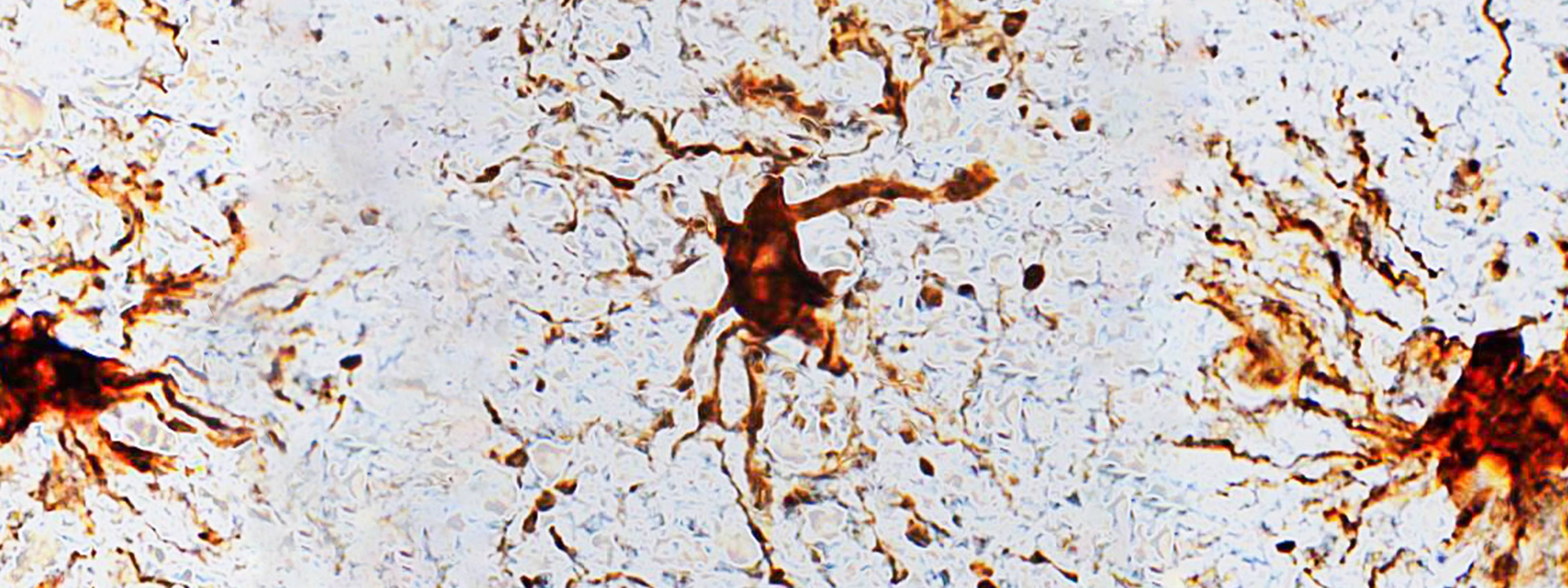 “Zombie” cells grow in the brain after death