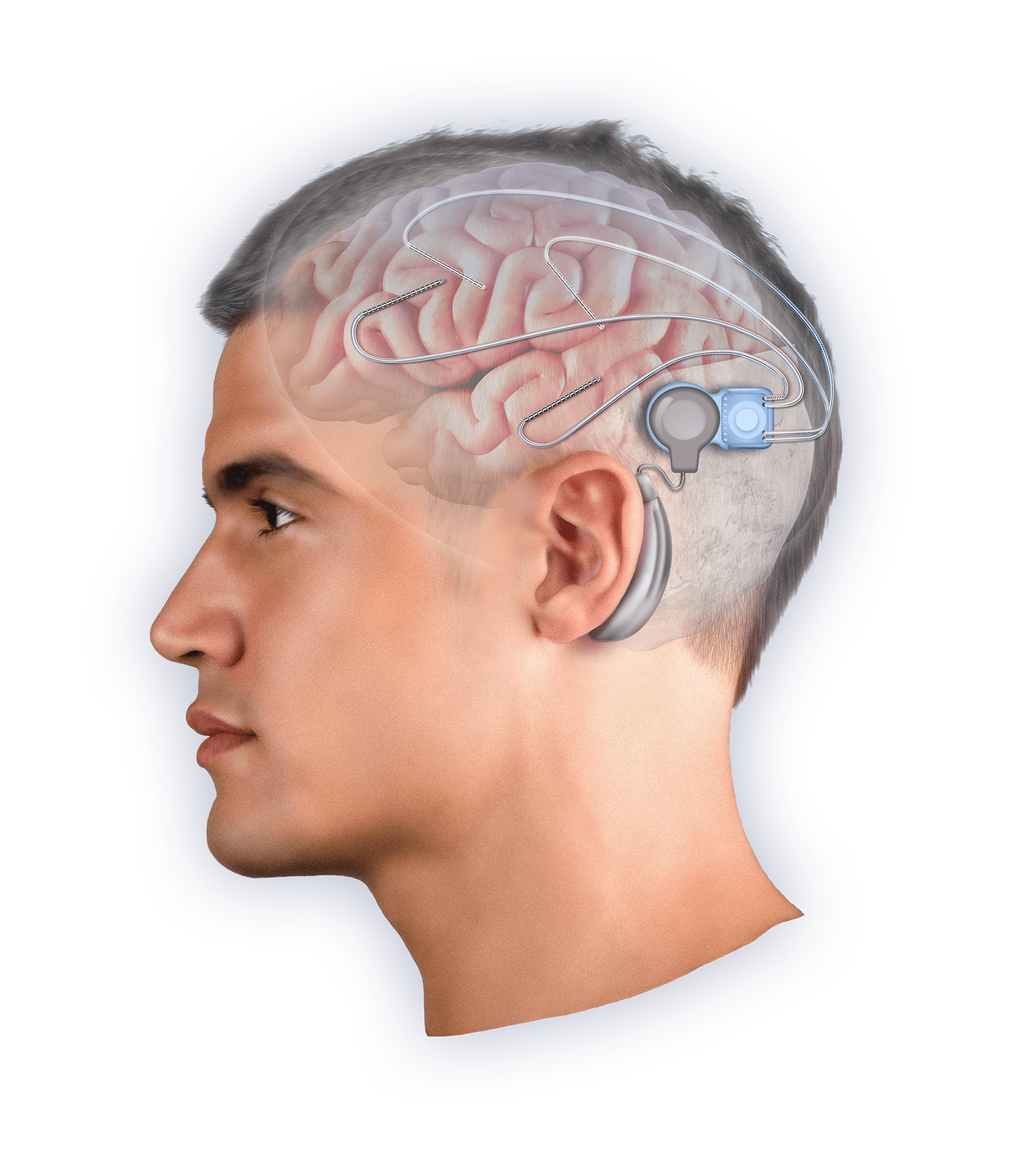 Scientists are developing brain implants that improve memory