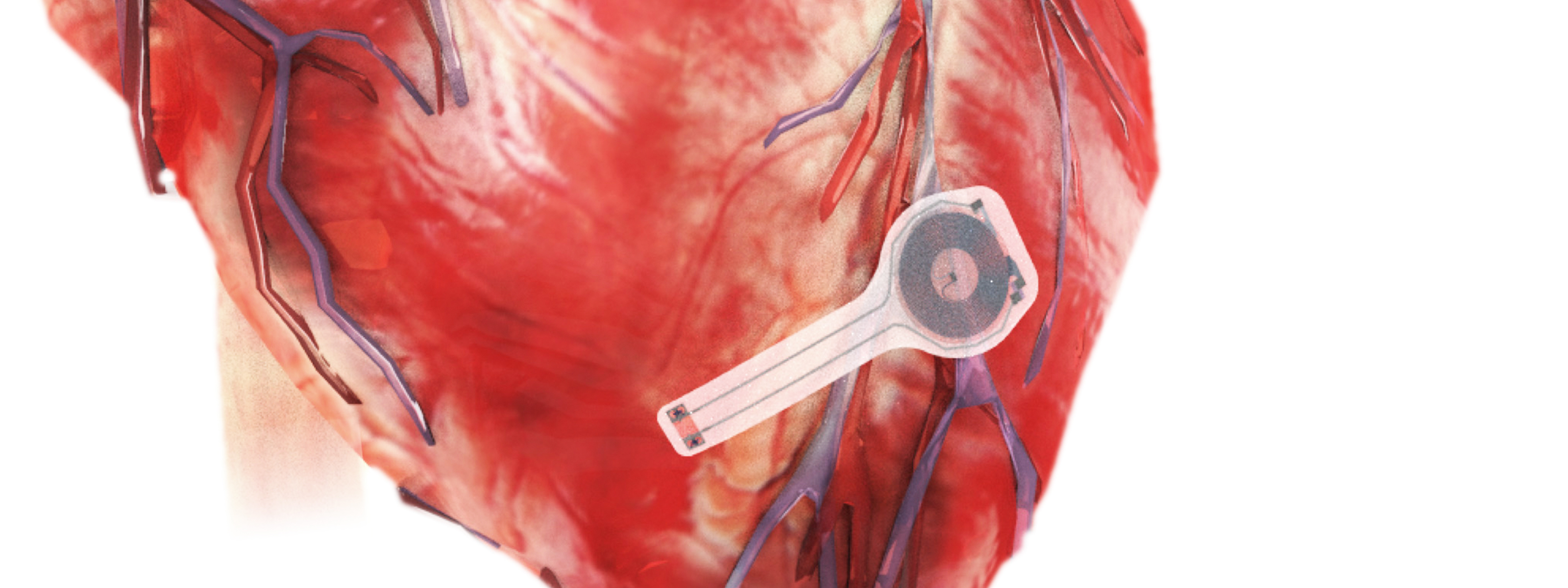 This Wireless Pacemaker Dissolves Into Your Body