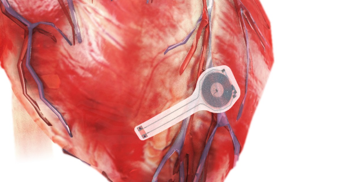This Wireless Pacemaker Dissolves Into Your Body