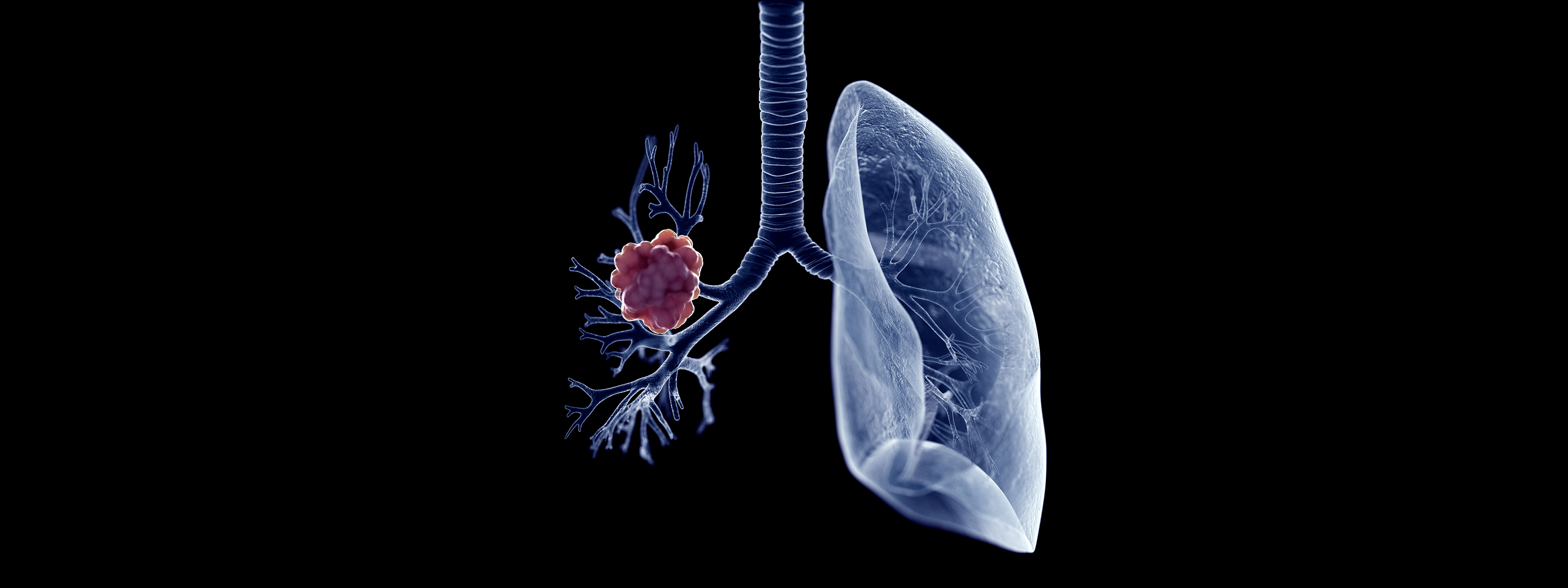Johns Hopkins has developed a lung cancer blood test