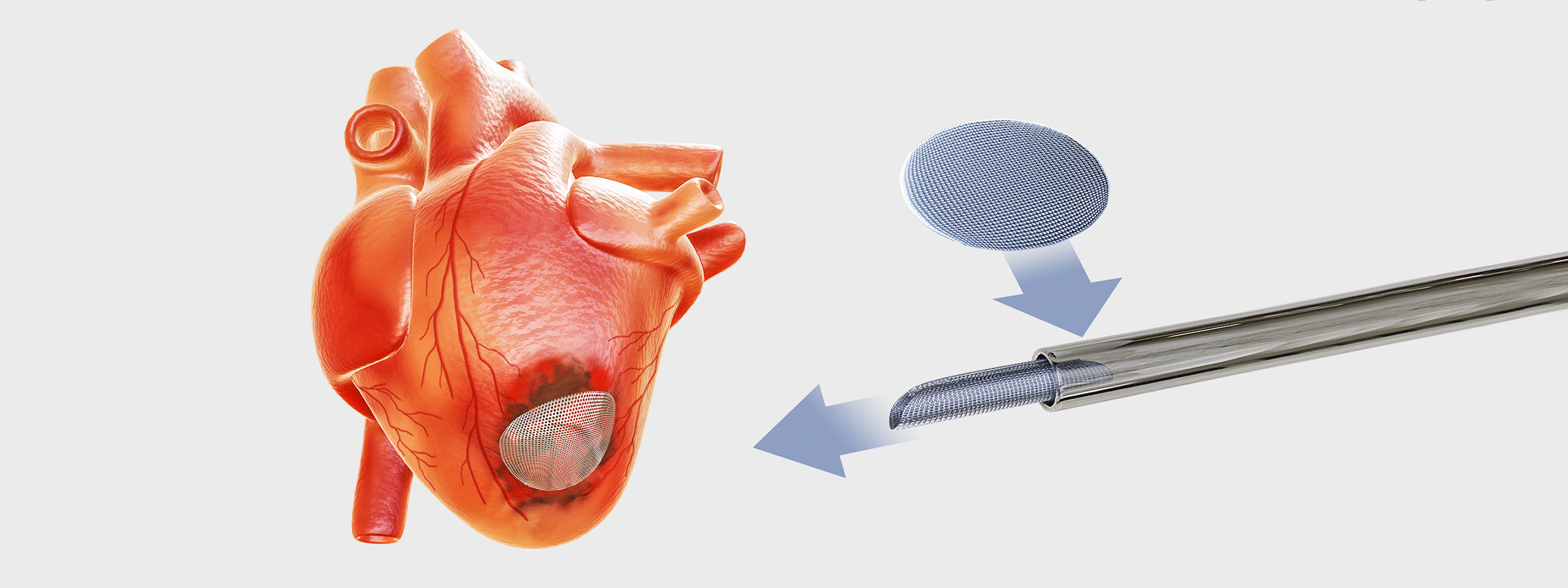 New cardiac patch can be implanted with a syringe