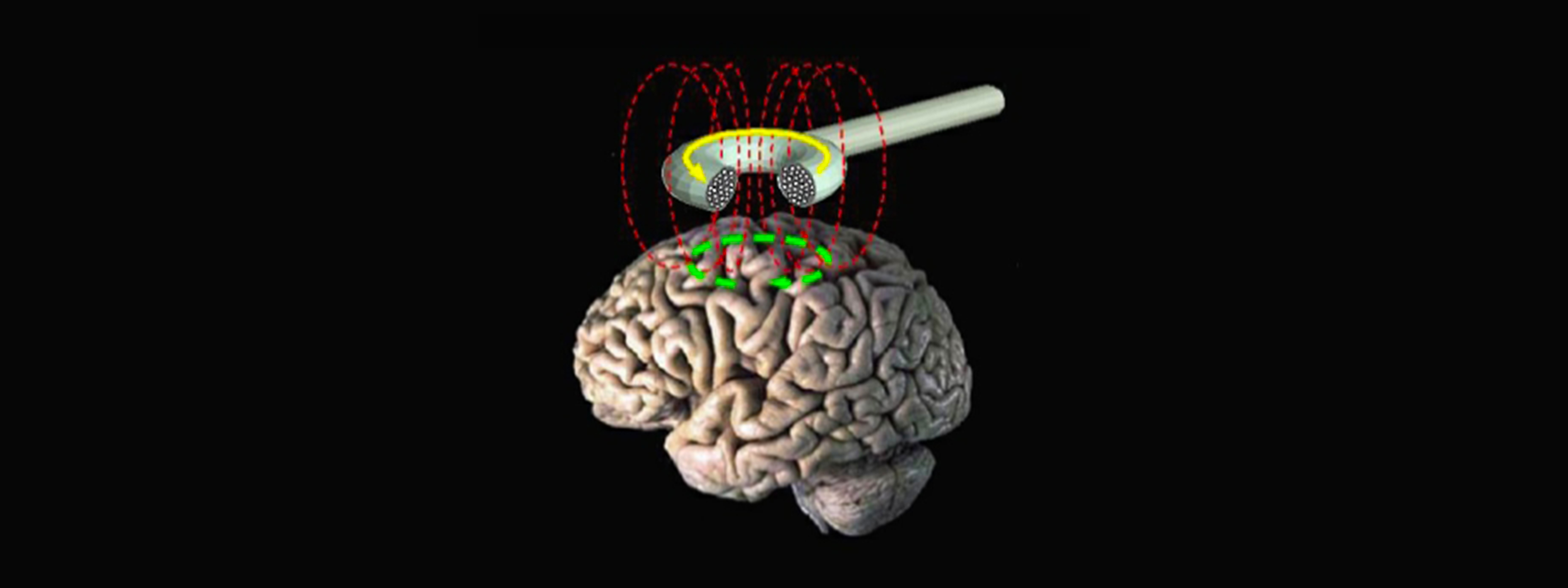 Magnetic brain stimulation nearly cures depression