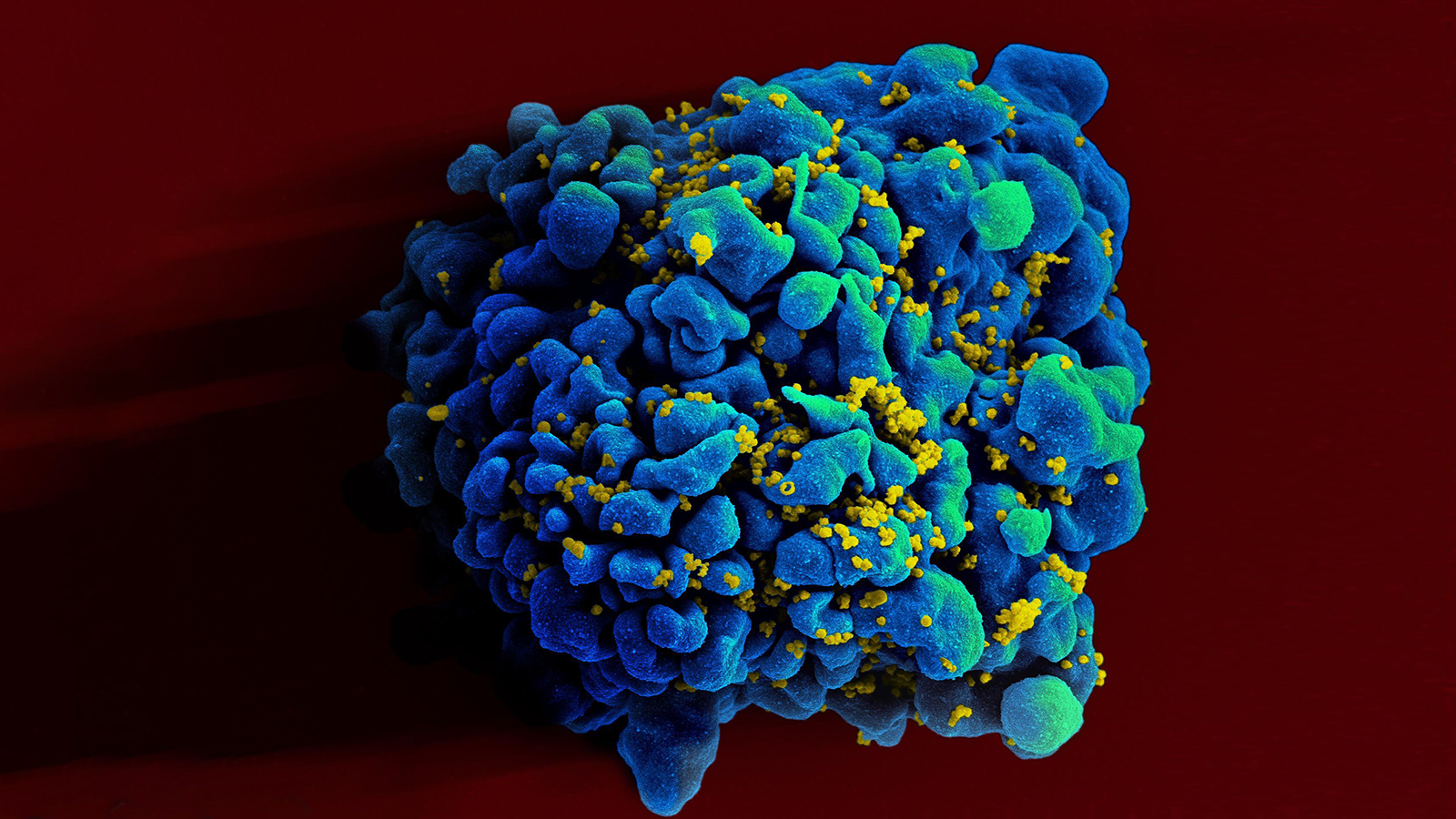 First woman cured of HIV through stem cell transplant