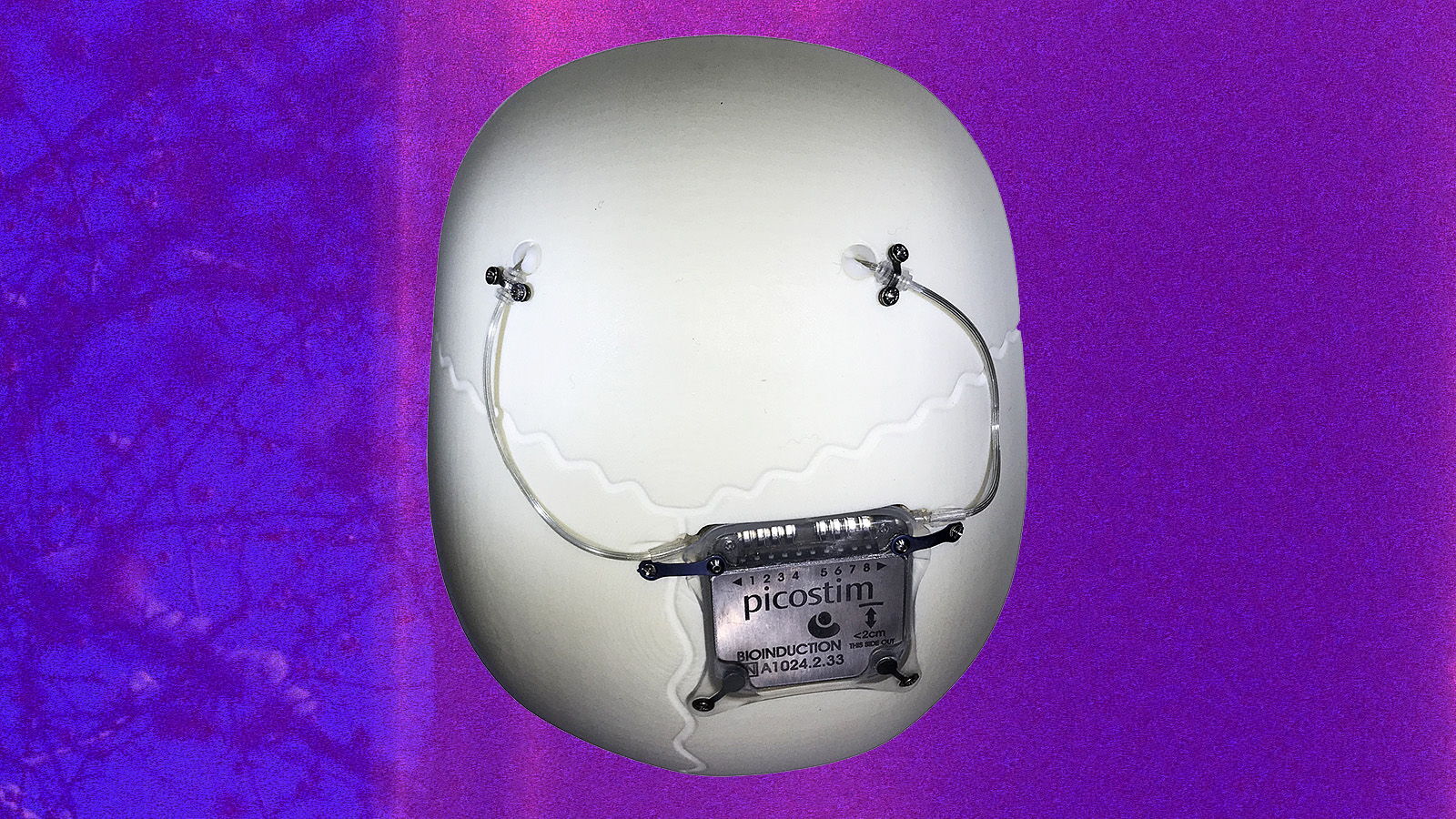 World’s smallest DBS device reverses Parkinson’s symptoms