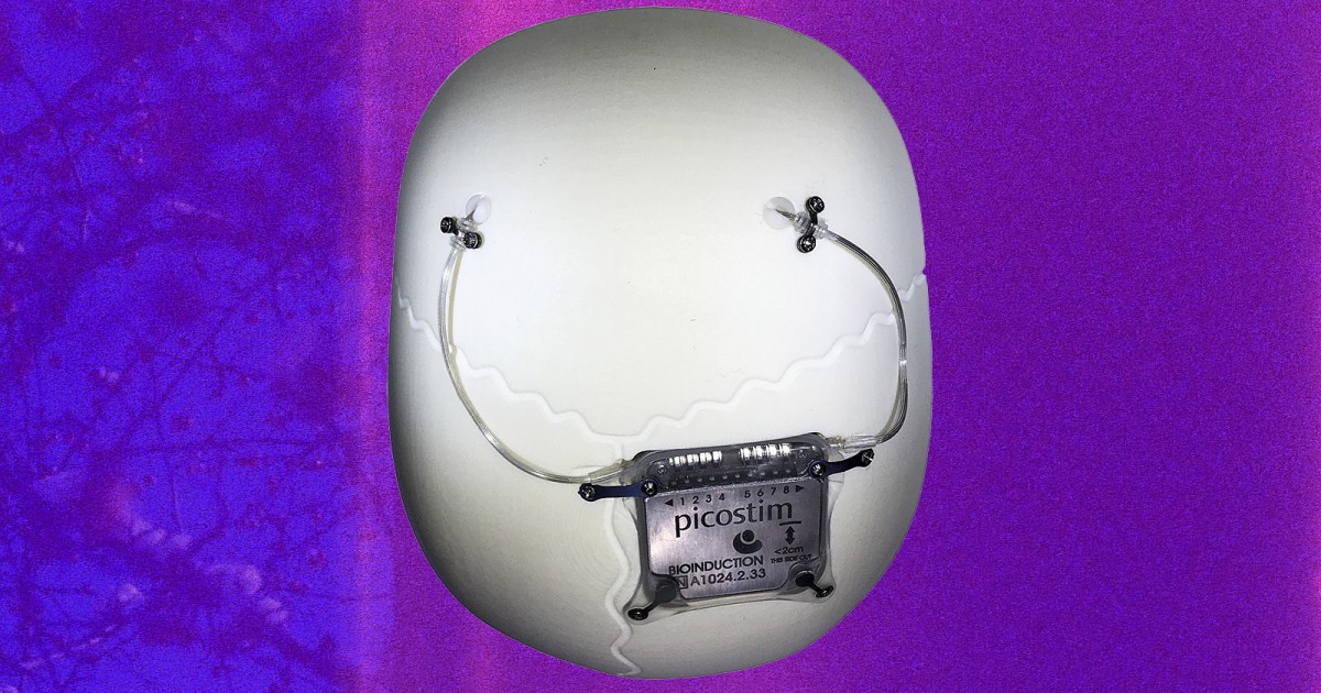 World’s smallest DBS device reverses Parkinson’s symptoms