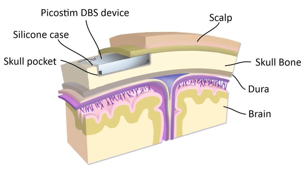 World’s smallest DBS device reverses Parkinson’s symptoms