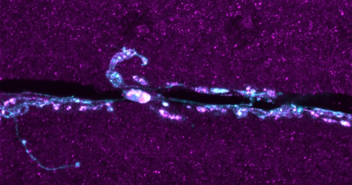 Potential cause of unexplained epilepsy cases uncovered