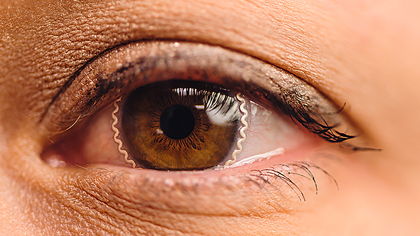 New smart contact lens monitors for glaucoma 24/7