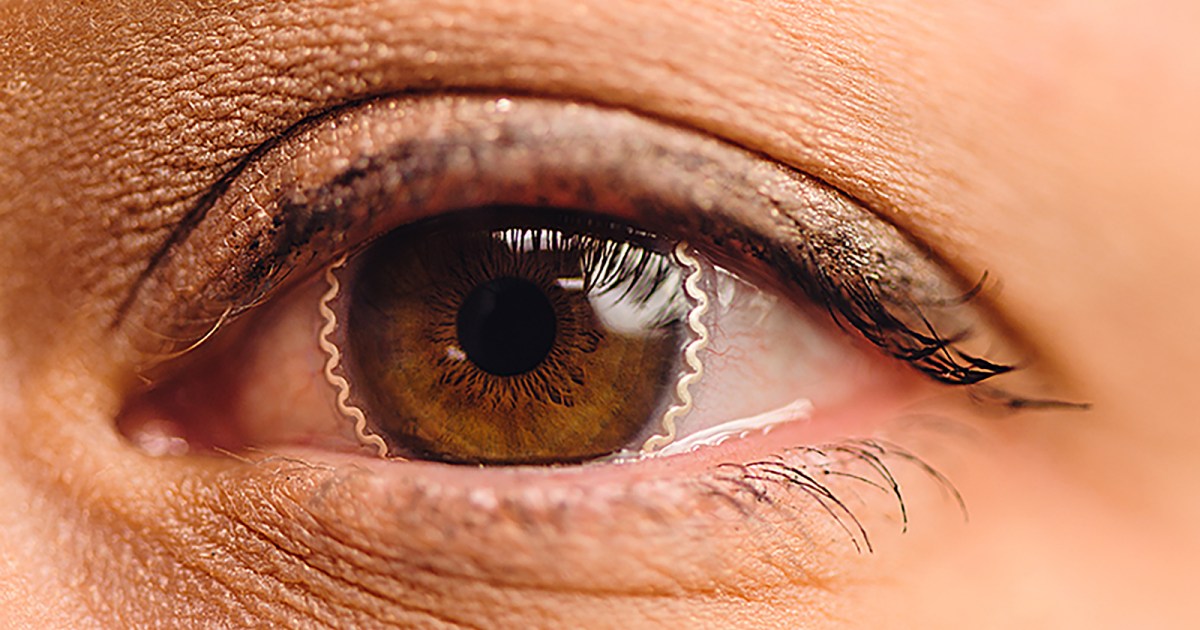 New smart contact lens monitors for glaucoma 24/7