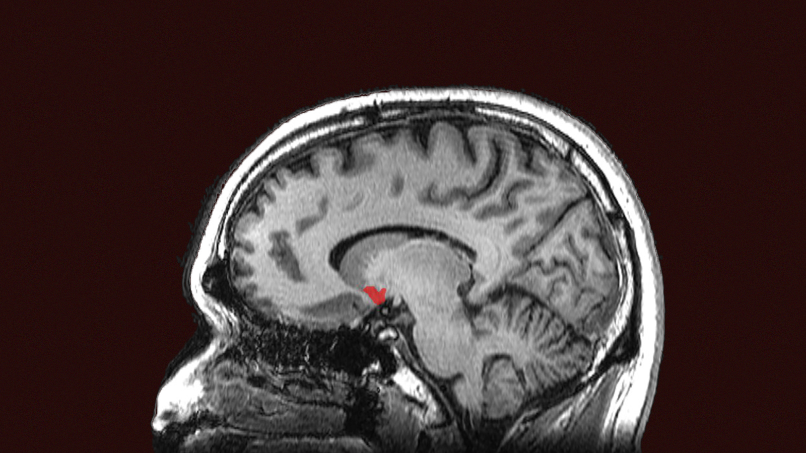 Electrically stimulating the brain helps stop binge eating disorder