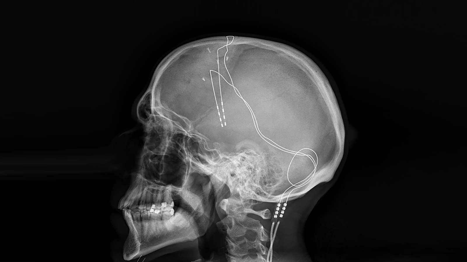 New deep brain stimulator is powered automatically by breathing