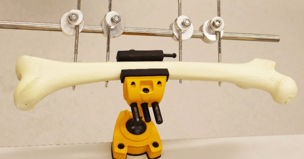 Treating broken bones in war zones made easier with low-cost device