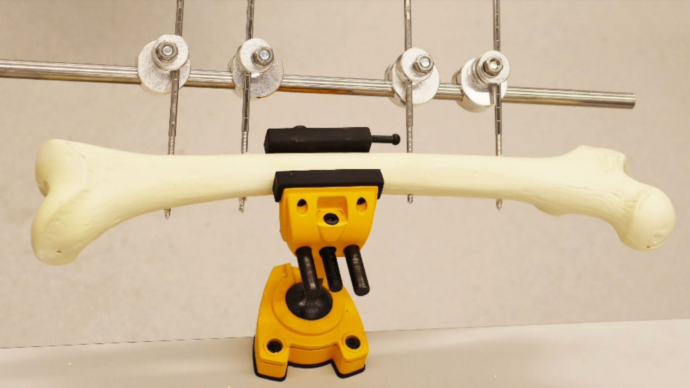 Treating broken bones in war zones made easier with low-cost device