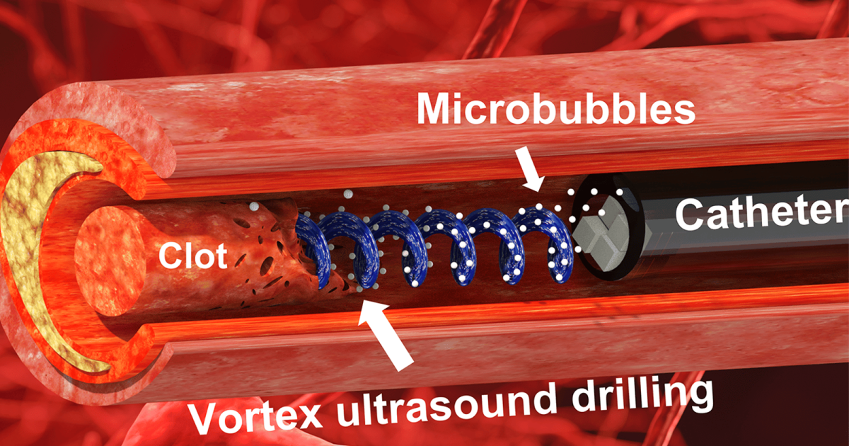 This “ultrasound vortex” can quickly clear blood clots