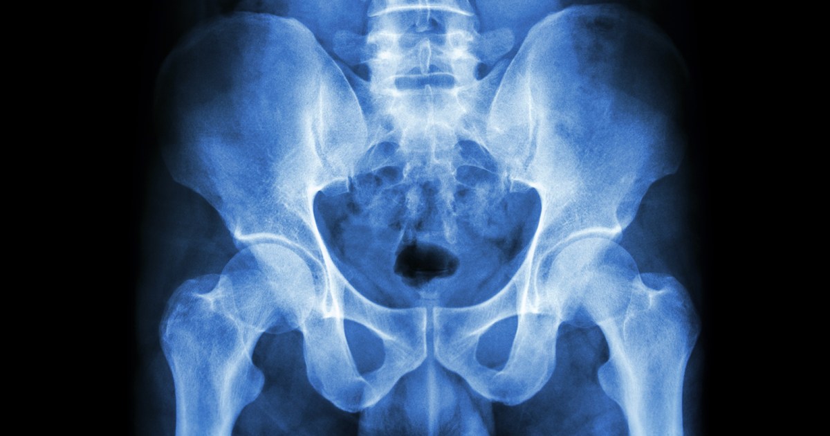 New drug could extend lives of people with deadly bone cancer