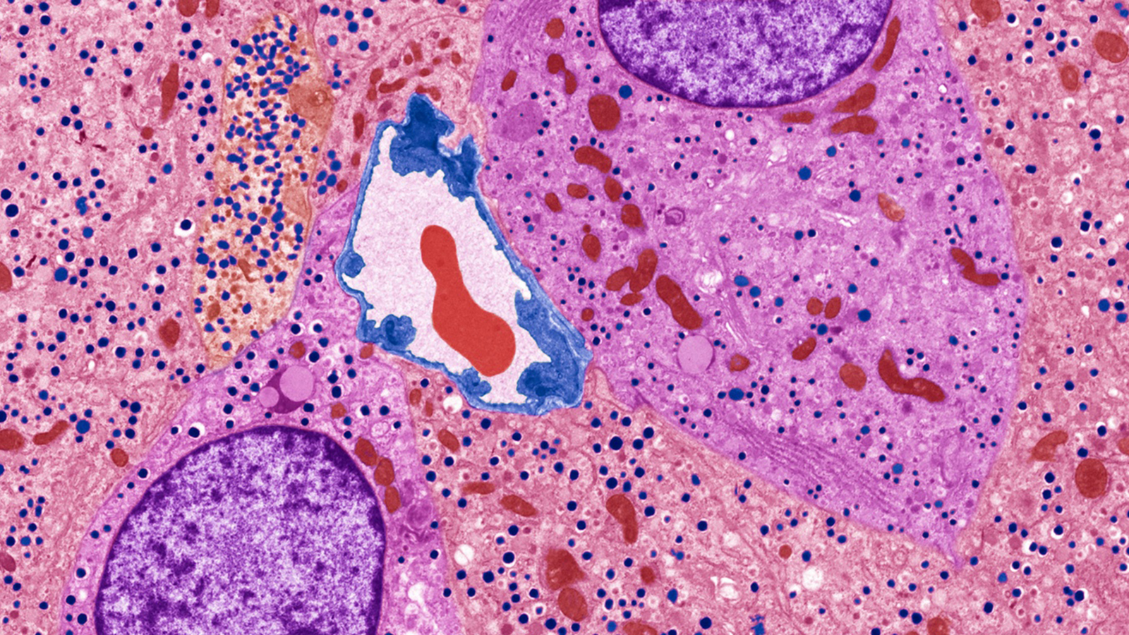 Type 1 Diabetes Pancreas Histology