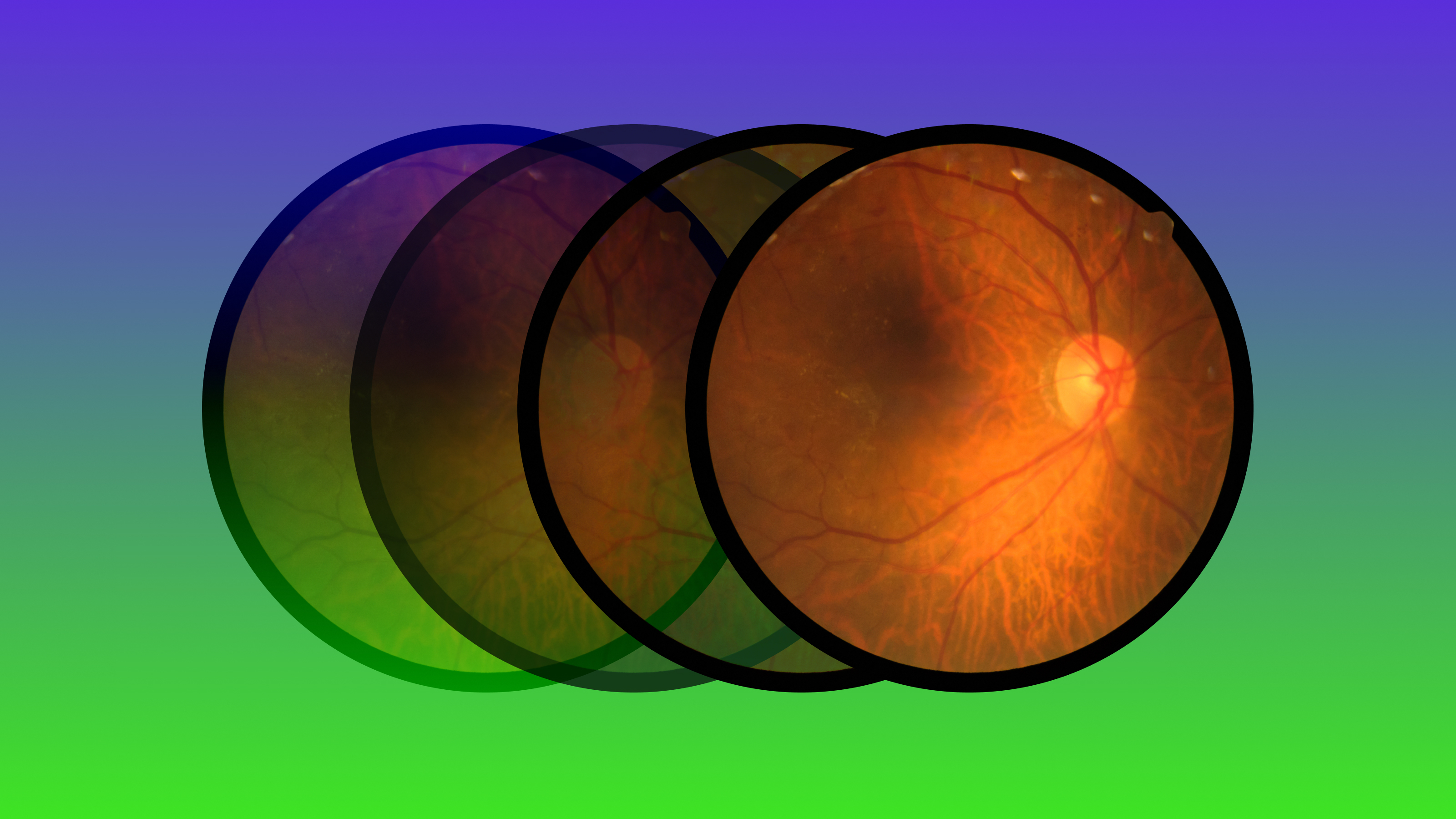 New gene therapy could reverse retinal degeneration