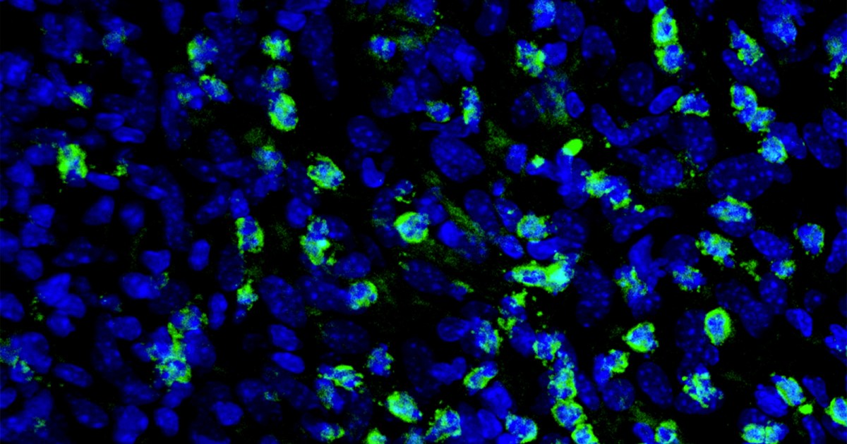 Existing heart drug may boost treatment for skin cancer