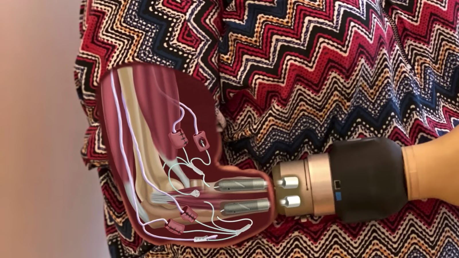 This bionic hand is fused to a woman’s bones, muscles, and nerves