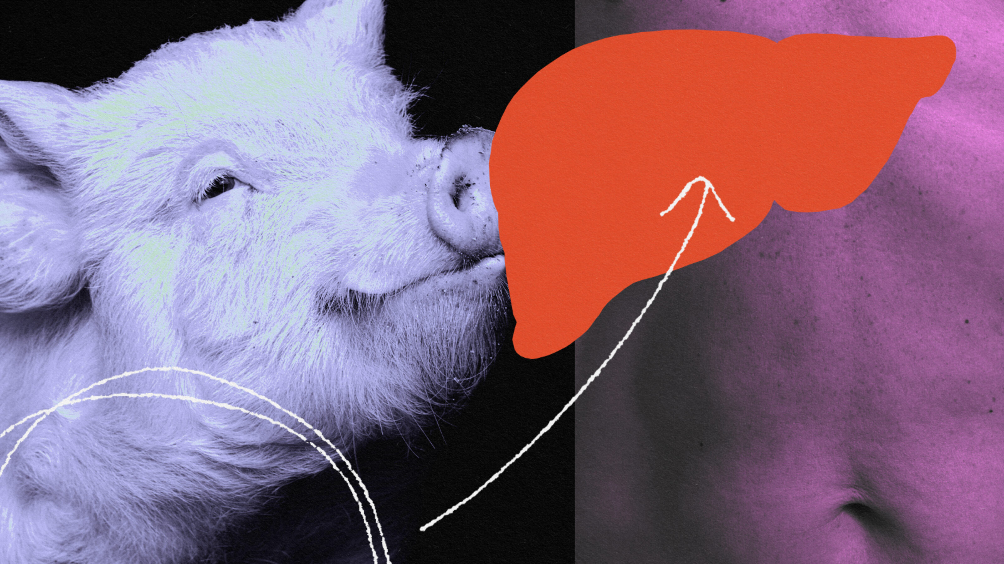 Pig liver filters blood outside a person’s body for 72 hours